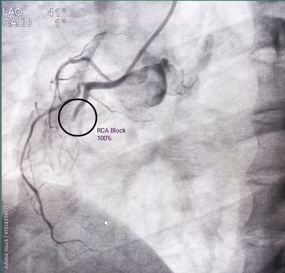 Coronary angiogram of right coronary artery during cardiac ...