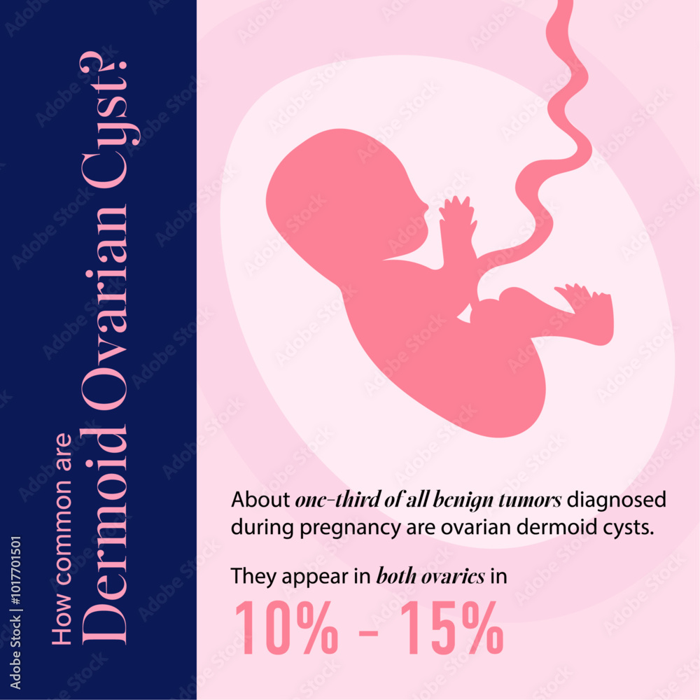 female reproductive system dermoid ovarian cyst percentage illustration ...