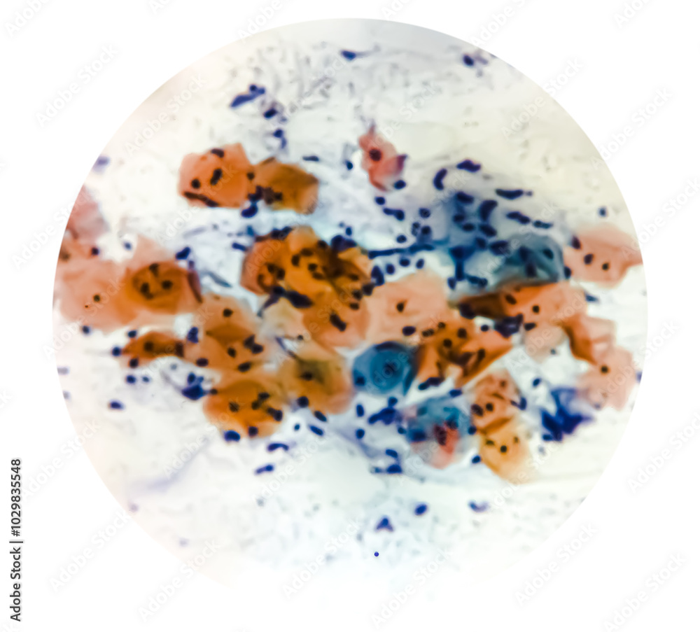 Light micrograph of a vaginal smear showing adenocarcinoma cells ...
