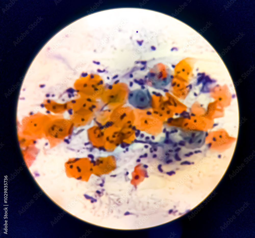 Light micrograph of a vaginal smear showing adenocarcinoma cells ...