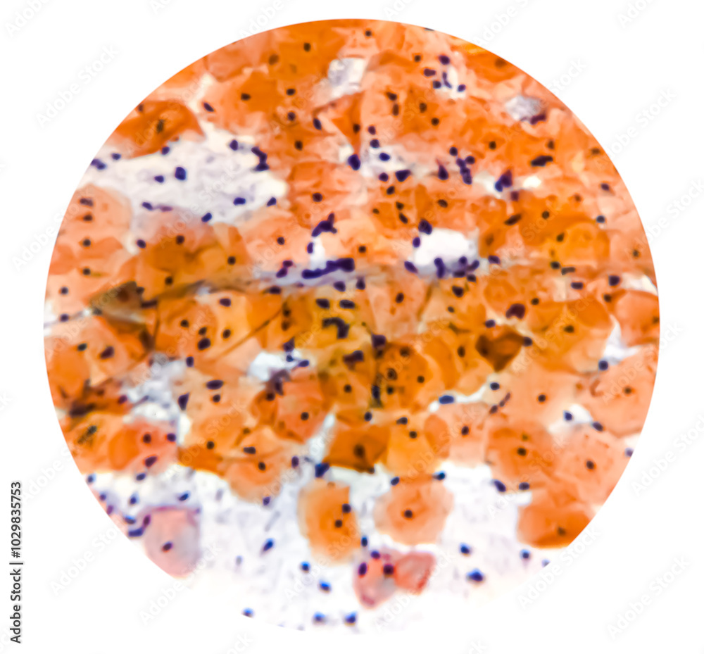 Light micrograph of a vaginal smear showing adenocarcinoma cells ...
