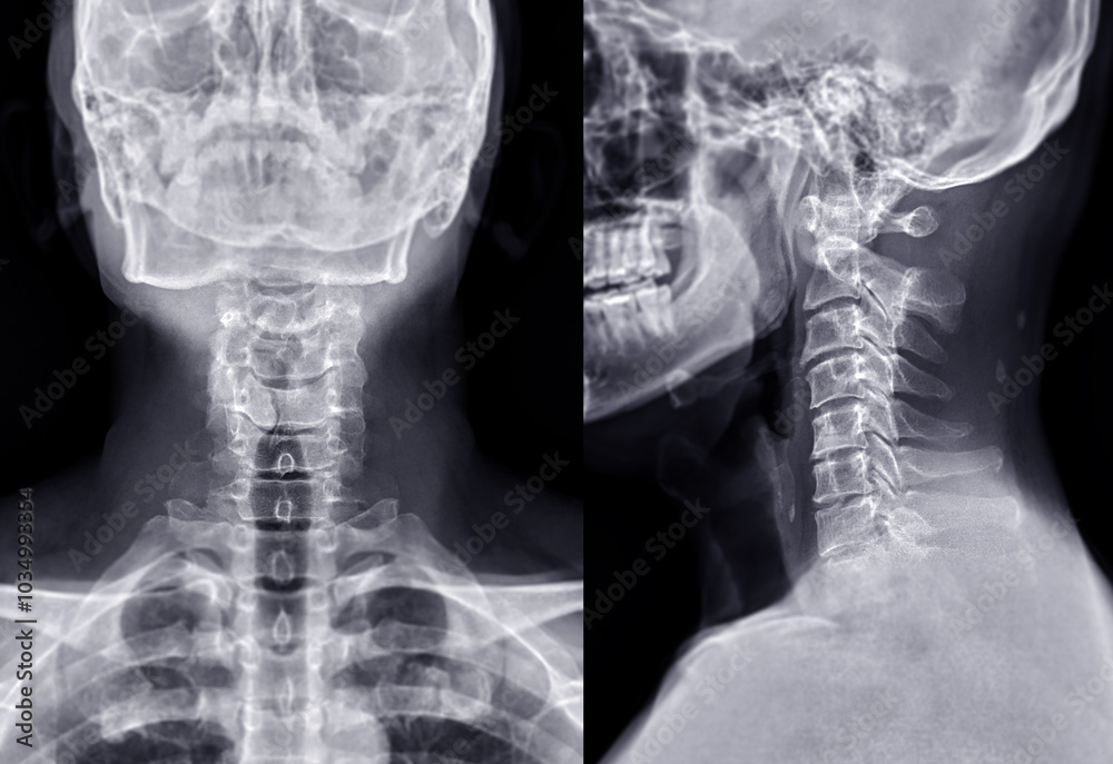 X-ray images of the cervical spine in AP and lateral views, showing ...