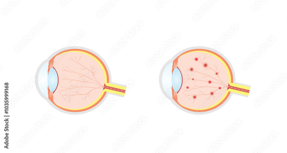 Diabetic retinopathy. Healthy eye and damaged eye. Retinal damage ...