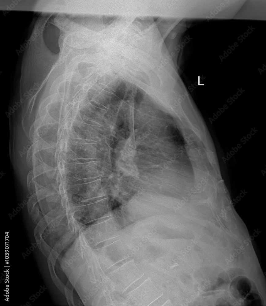 Lateral Chest X-Ray for Lung and Thoracic Analysis Stock Photo | Adobe ...