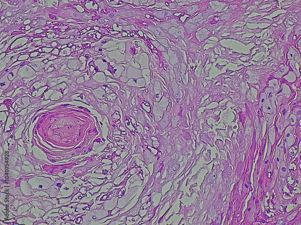 Photomicrograph seborrheic keratosis of the Skin, hematoxylin eosin ...