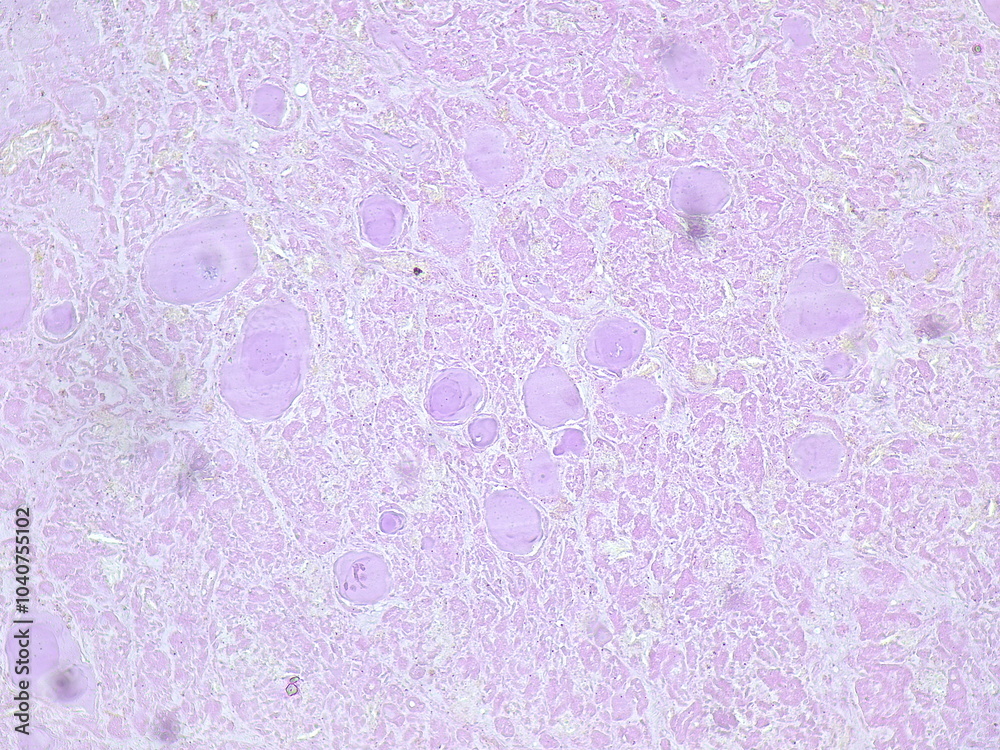 Photomicrograph showing histology of a benign thyroid nodule in a ...