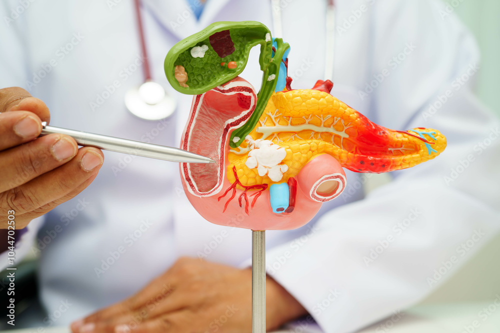 Pancreatitis, pancreatic cancer, Asian doctor with pancreas ...