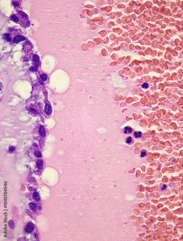 This photo shows the pink myxoid stroma of an atrial myxoma, with cords ...