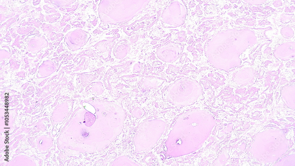 Photomicrograph showing histology of a benign thyroid nodule in a ...