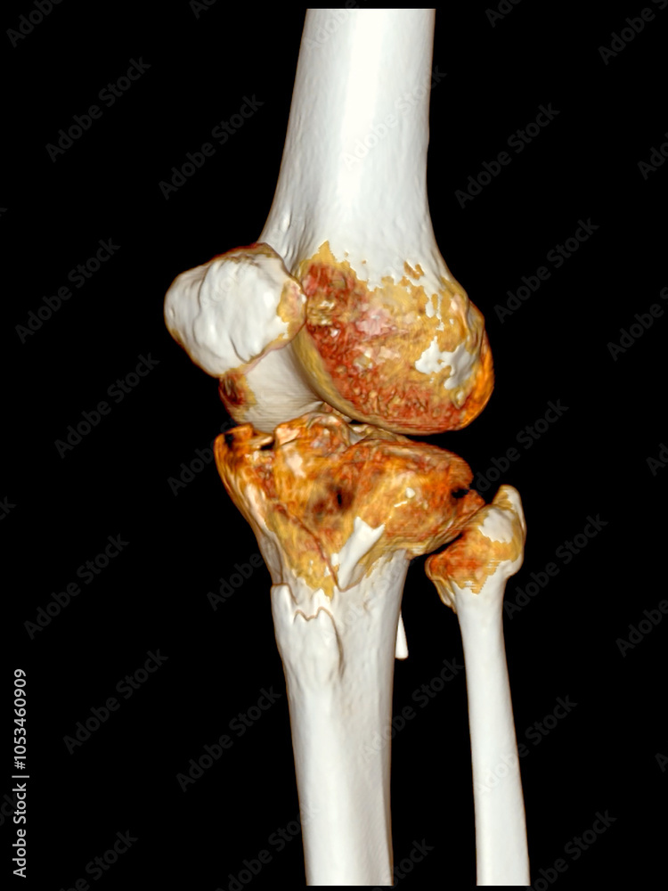 Trauma Case: Tibia and Fibula Fracture in 3D CT Scan.A detailed 3D medical scan showing ...