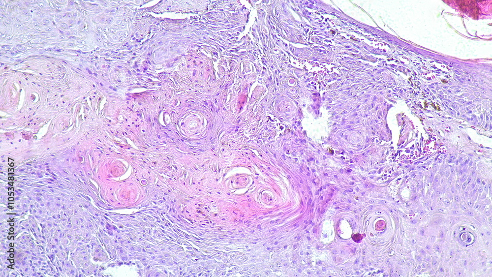 Photomicrograph seborrheic keratosis of the Skin, hematoxylin eosin ...