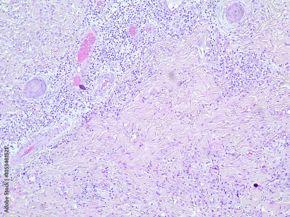 Stock-Foto „Photomicrograph showing histology of a Fibrolipoma, benign ...