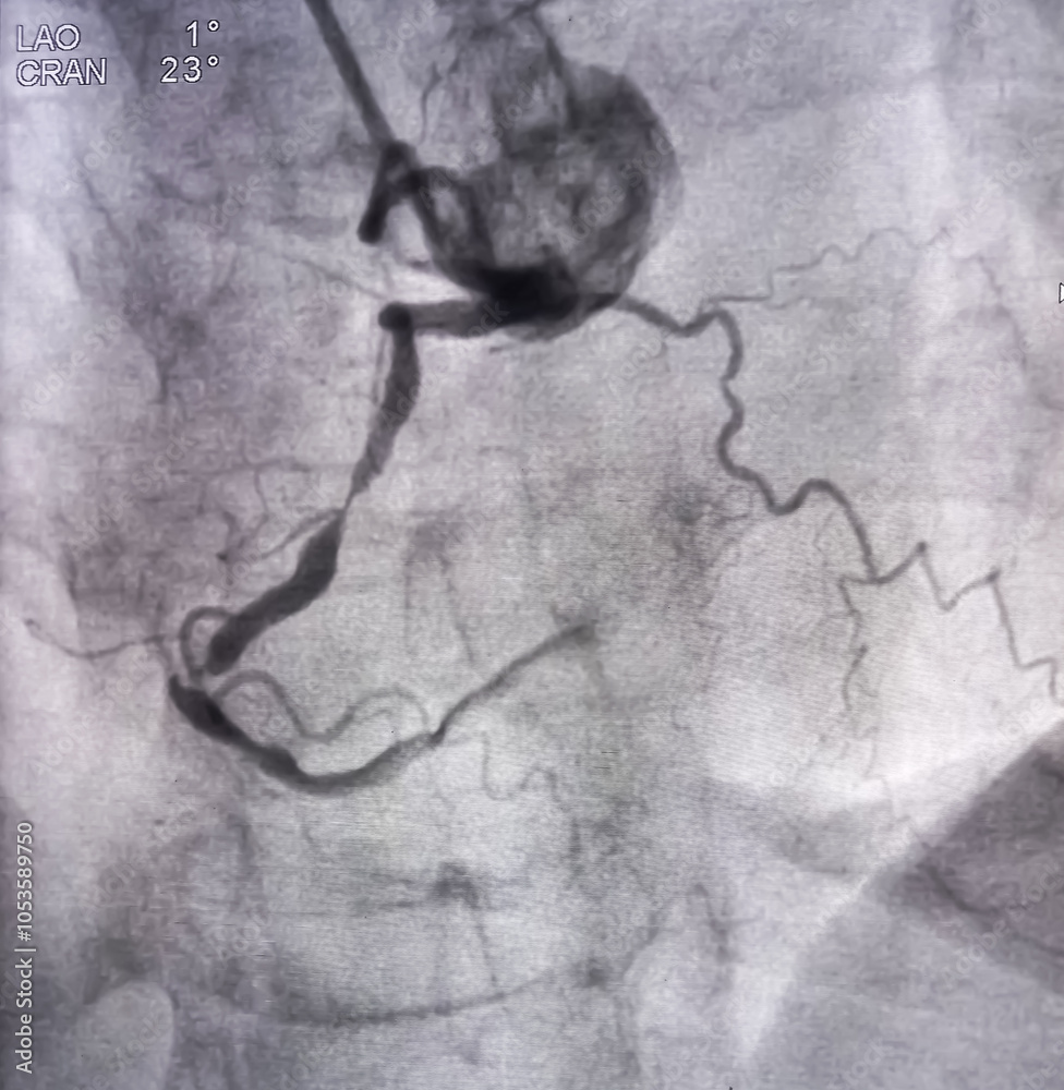 Coronary angiogram of right coronary artery during cardiac ...