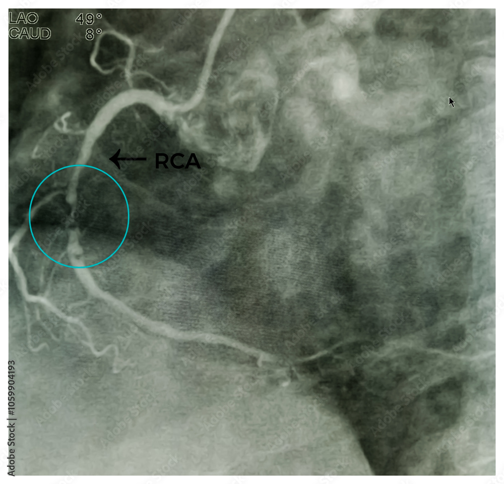 Coronary angiogram of right coronary artery during cardiac ...
