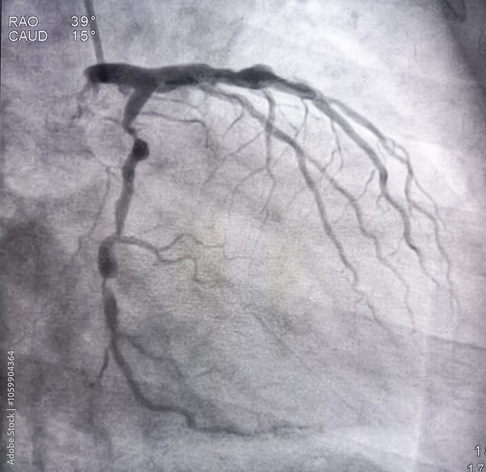 Coronary angiogram of left coronary artery during cardiac ...