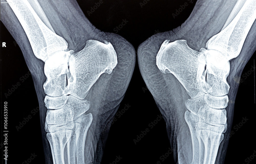 Plain X ray of female patient foot shows calcaneal heel spur, bony ...