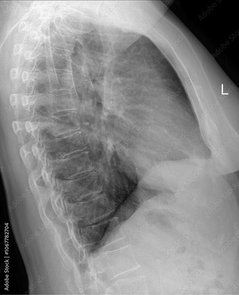 Radiographic Chest X-Ray Showing Trachea, Bronchi, and Lung Parenchyma ...