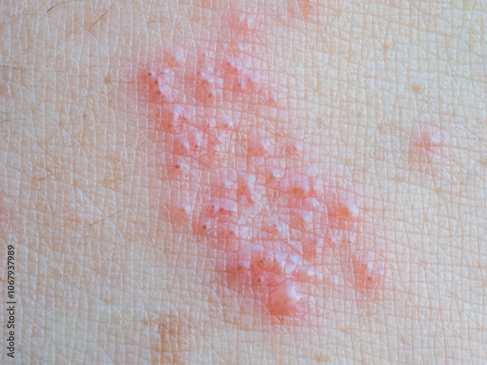 Shingles (Herpes Zoster, Shingles) is a type of skin disease. This is ...