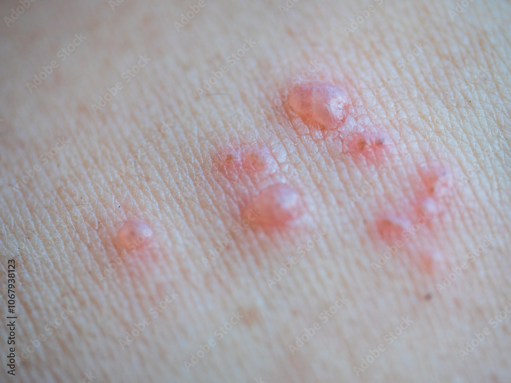 Shingles (Herpes Zoster, Shingles) is a type of skin disease. This is ...