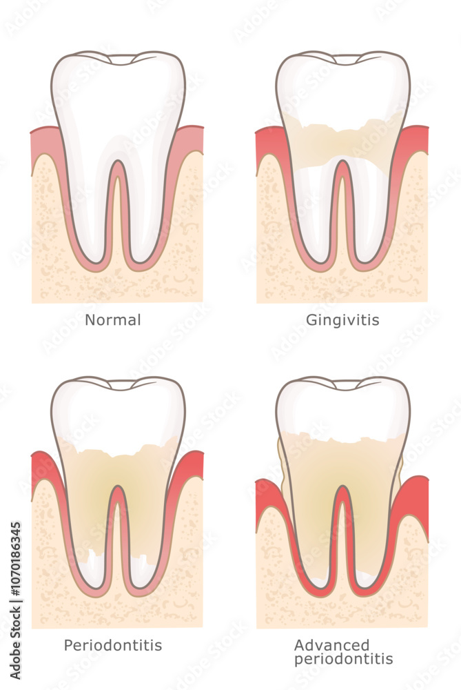 Praca wektorowa bez tantiem: Gum inflammation stages gingivitis and ...