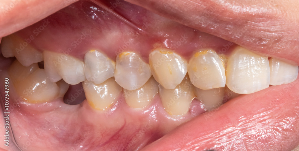 Lateral view of dental arches in biting occlusion with a lost lower ...