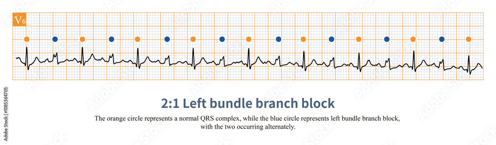 When a 2:1 bundle branch block occurs, the refractory period of the ...