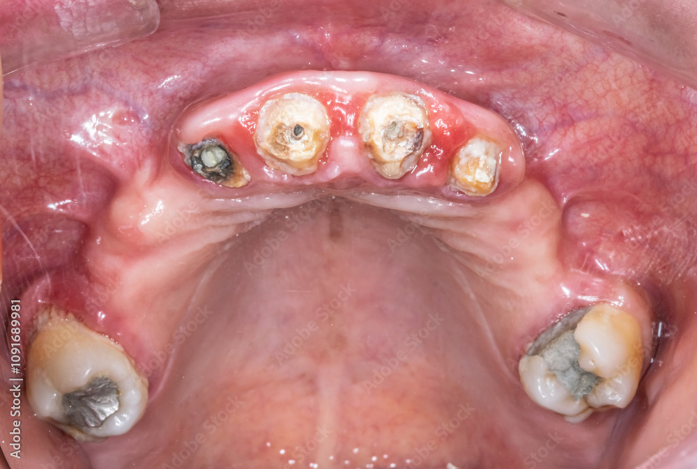 Maxillary arch with unhealthy gingival gum, decayed anterior teeth with ...