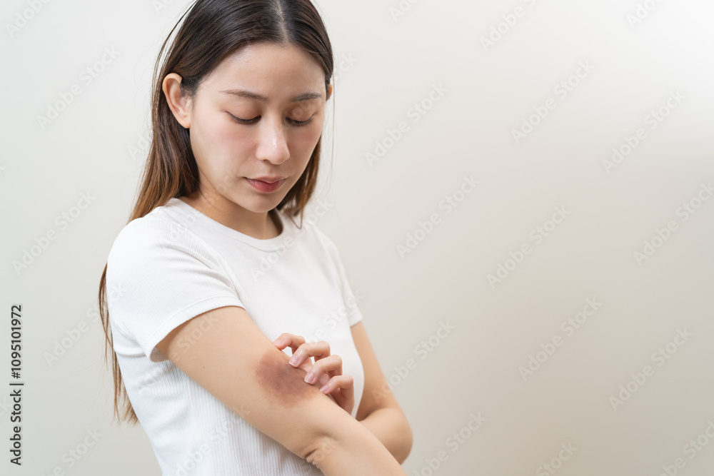 Close up of stain bruise wound on arm, contusion asian young woman ...