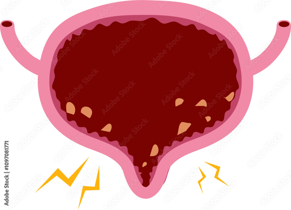 Bladder disease illustration. Urinary tract infection. Bladder cancer ...