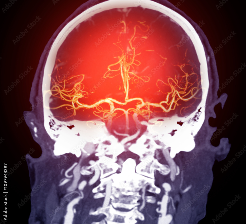 The contrast-enhanced CT Angiography (CTA) of the brain and neck ...