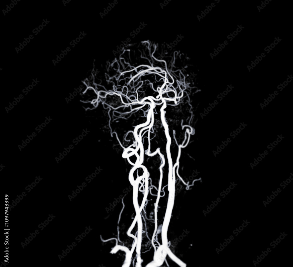 The CT Angiography (CTA) scan of the brain and neck, showcasing the ...