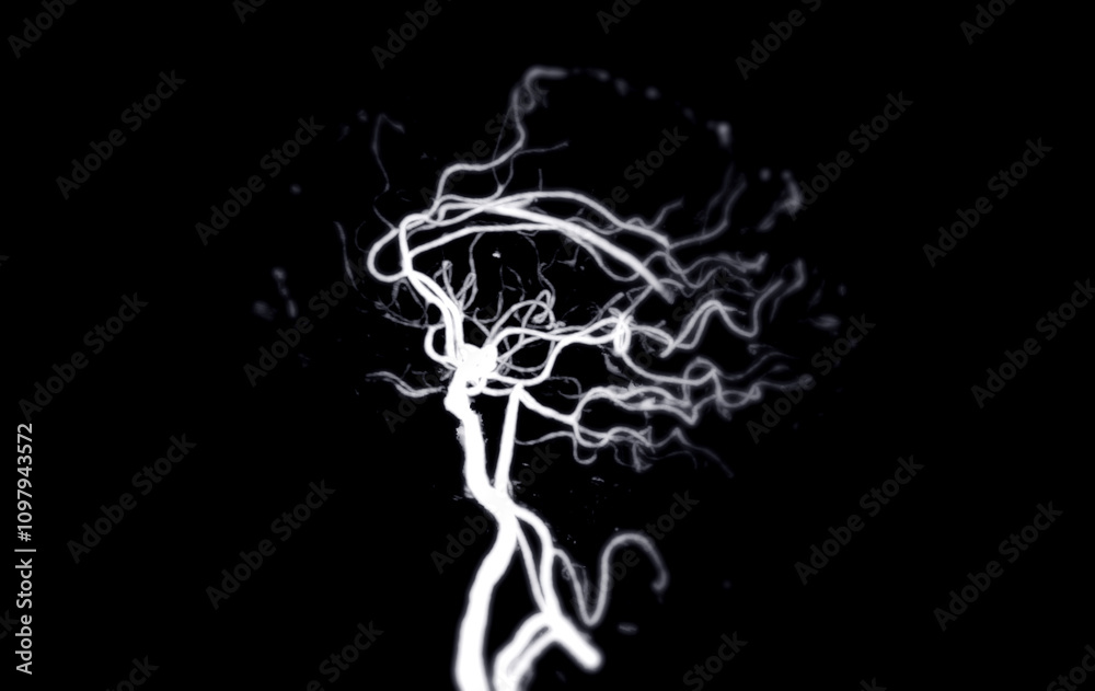 3d reconstruction; anatomy; aneurysm; angiogram; angiography; artery ...