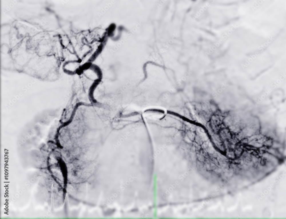 The angiographic view of the hepatic artery during embolization. The ...