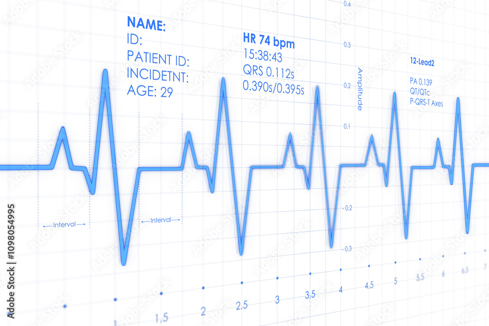 Blue ECG signal graph with patient data on white grid background, clean ...