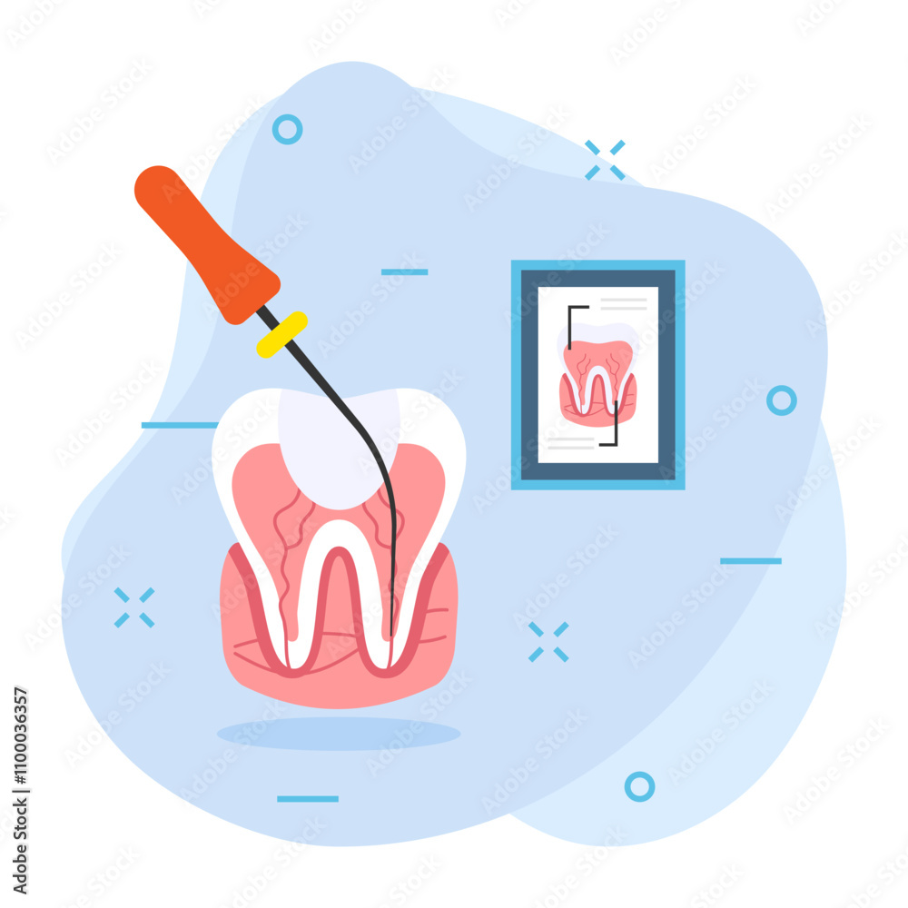 Endodontic therapy Root canal treatment Concept, dental examination ...