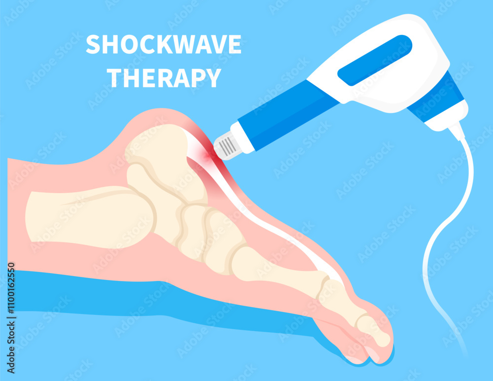Foot pain treatment with Shockwave therapy to treat muscle repetitive ...