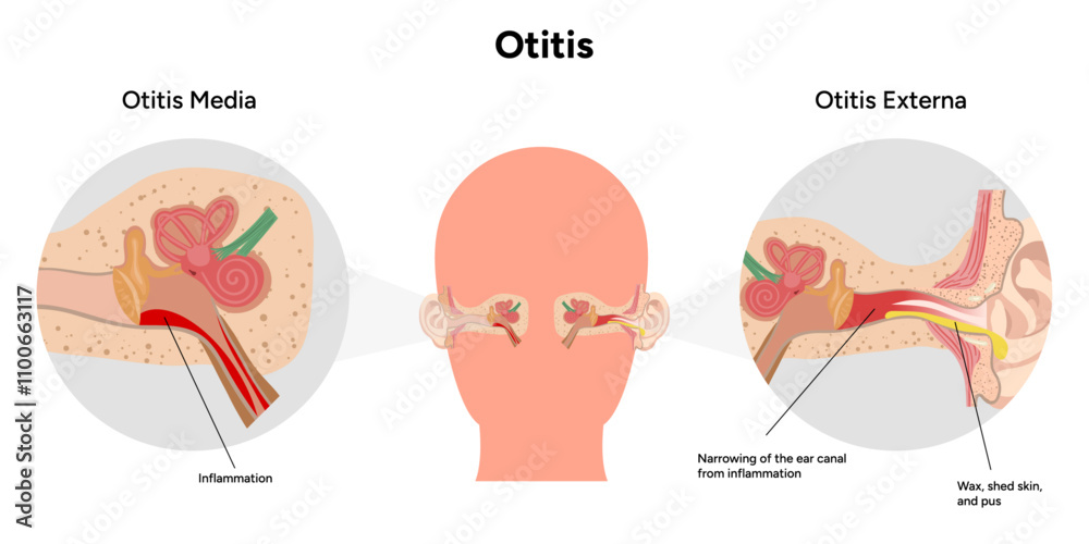 Otitis media and externa inflammation anatomy human ear pain disease ...