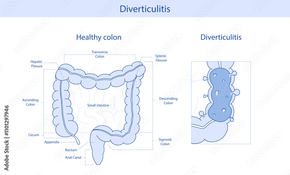 Intestinal diverticulitis. anatomical illustration of the rectum ...