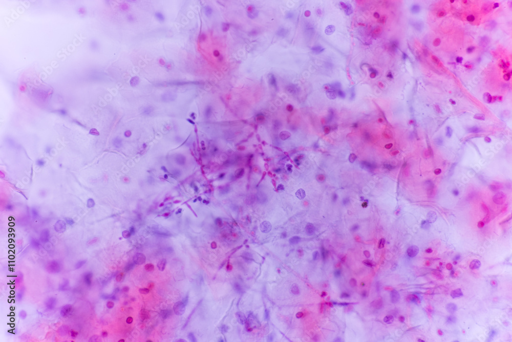 View in microscopic of Candidiasis, fungal infection (Yeast and ...
