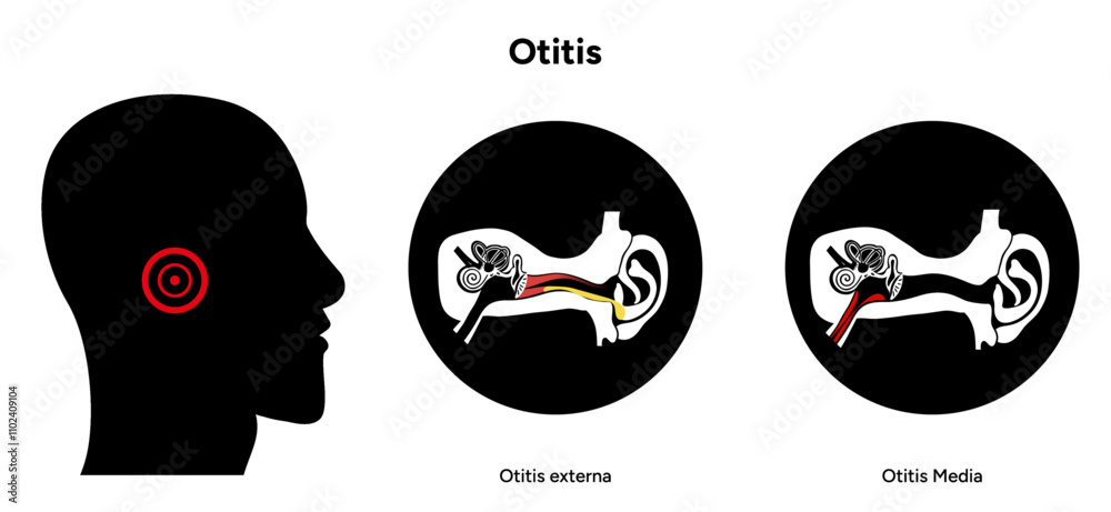 Otitis media and externa human ear anatomy disease medical infographic ...
