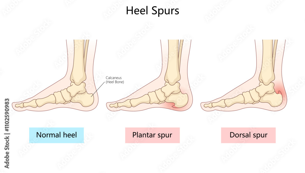 Vector de Stock normal heel, plantar spur, and dorsal spur, showing ...