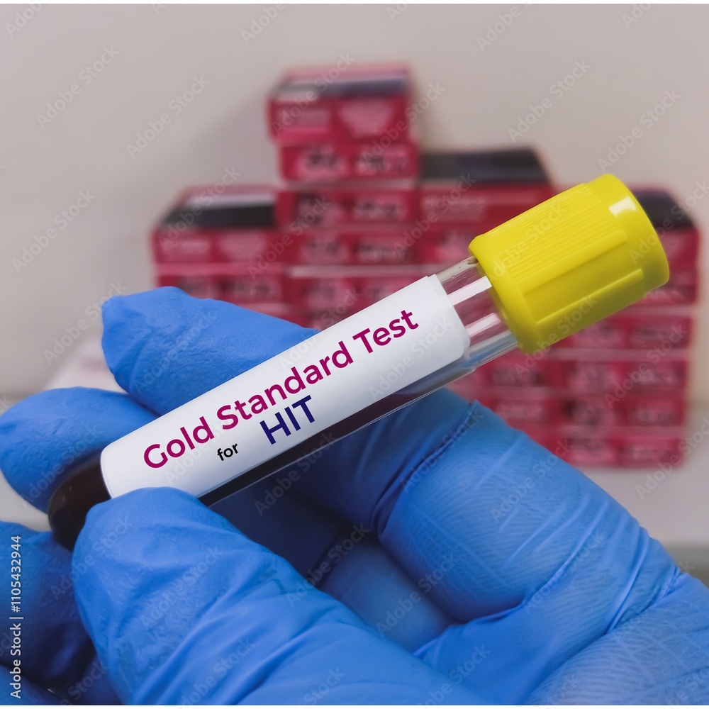 Blood sample for Heparin Induced Thrombocytopenia (HIT) PF4 Antibody ...