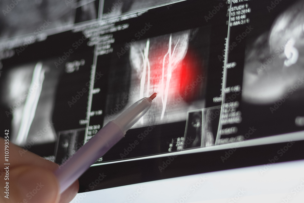 Doctor examining MRI neck spine. X-ray scan. Spondylosis of the ...