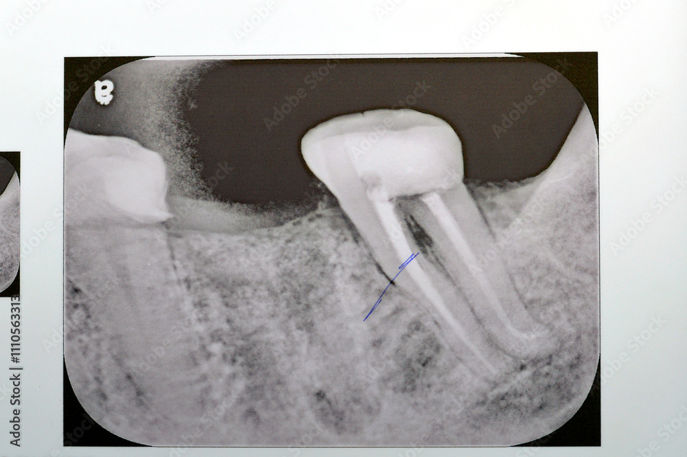 Lower molar periapical x-ray with root canal treatment with coronal ...