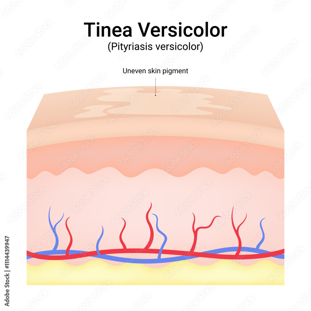 Fungal infection of tinea versicolor skin Stock Vector | Adobe Stock
