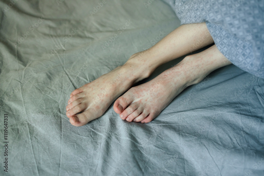 Stock-Foto „Close up of Child's legs with many red spot. A sick child ...