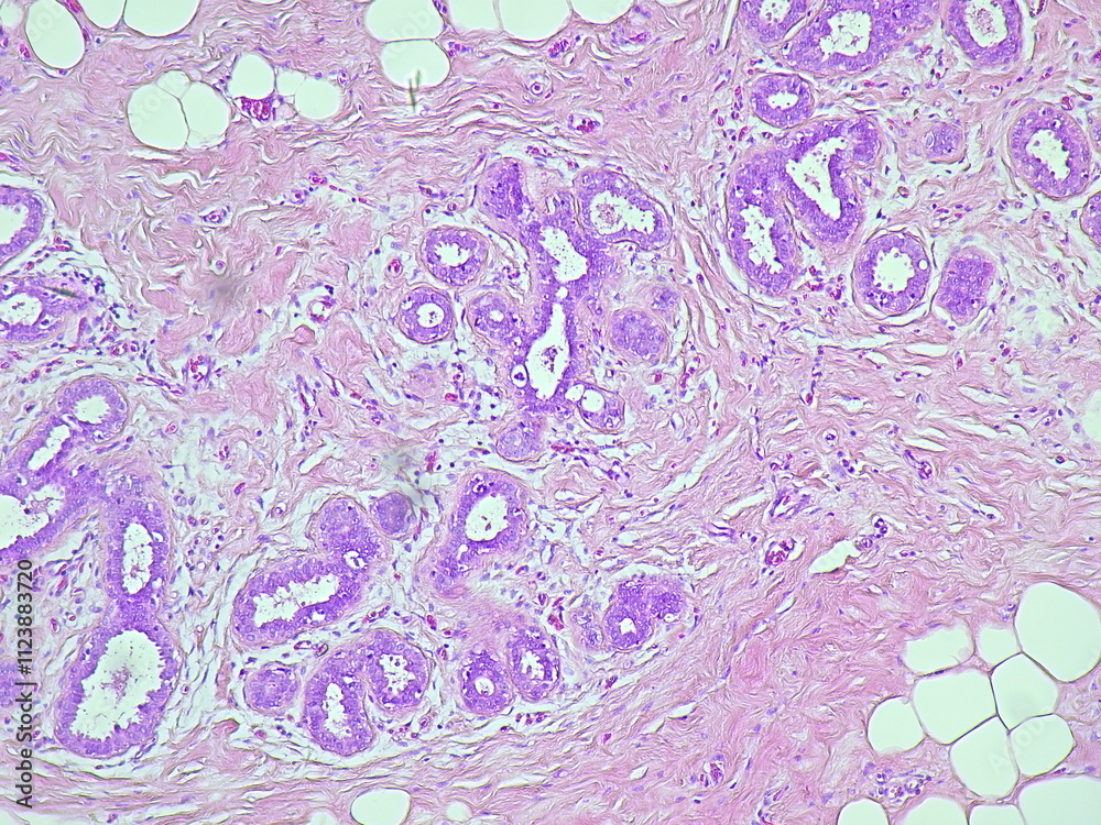 Human breast cell tissue under a microscope in a pathology laboratory ...