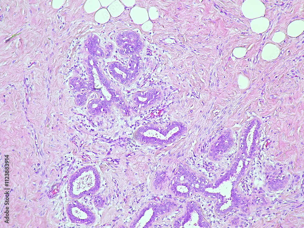 Human breast cell tissue under a microscope in a pathology laboratory ...