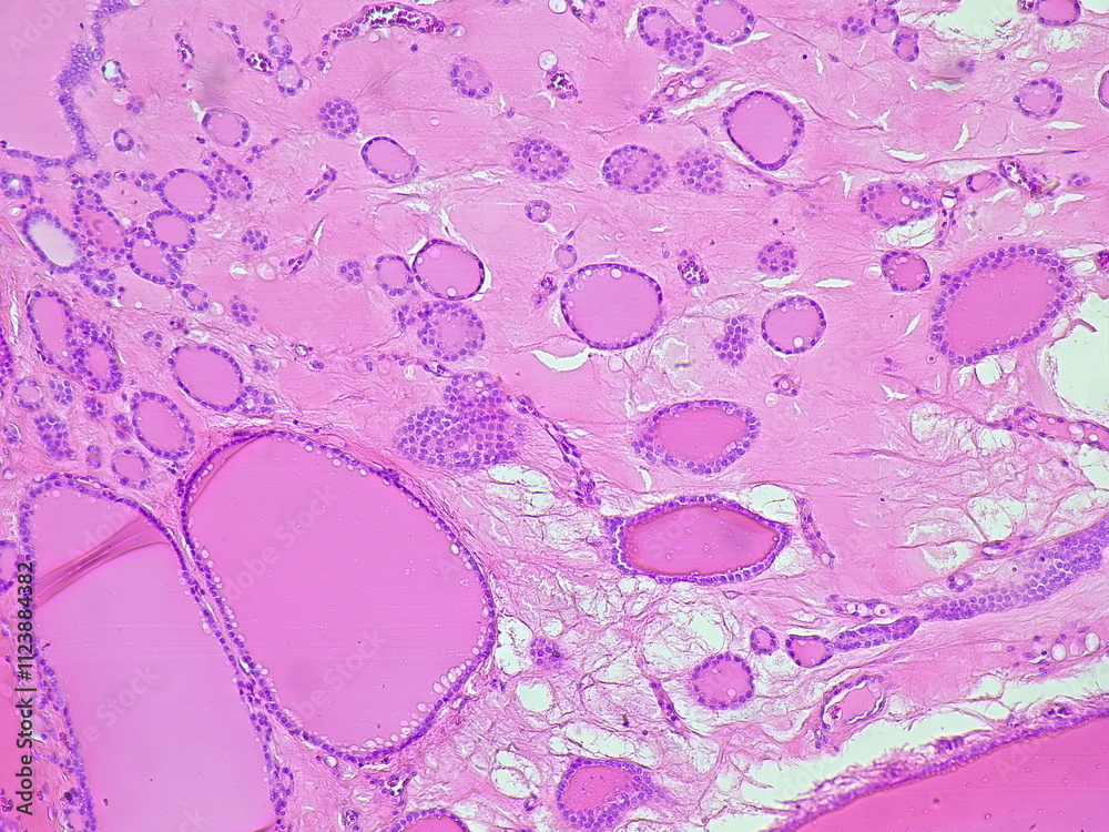 Photomicrograph showing histology of benign thyroid nodule under ...