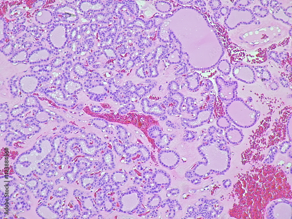 photomicrograph of Hashimoto's thyroiditis (chronic lymphocytic thyroiditis) in pathology ...
